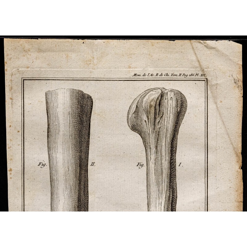 1787 - Moignon d'amputation