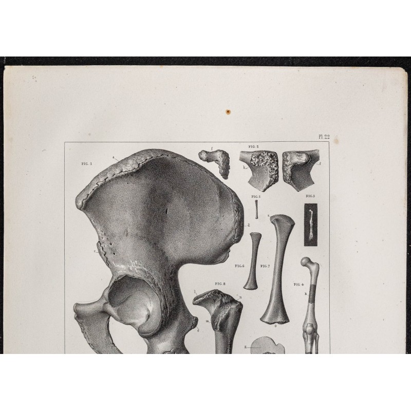 1864 - Os iliaque de la hanche et fémur
